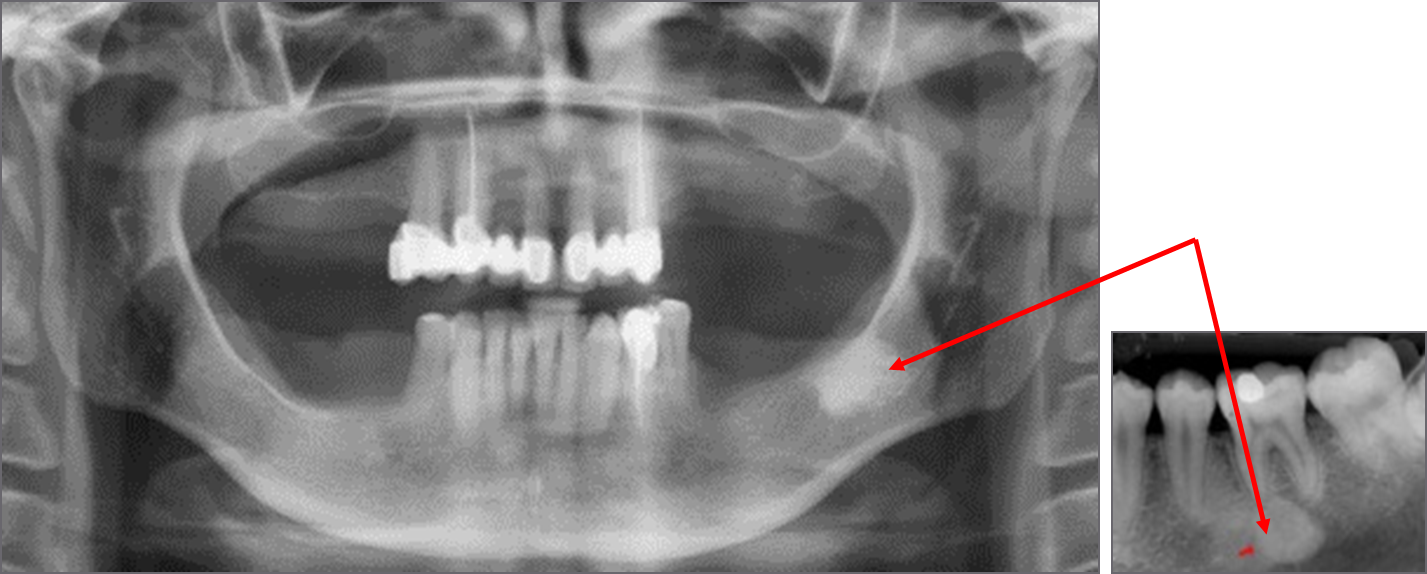 Radiología oral y maxilofacial: Interpretación de patologías pulpares y ...