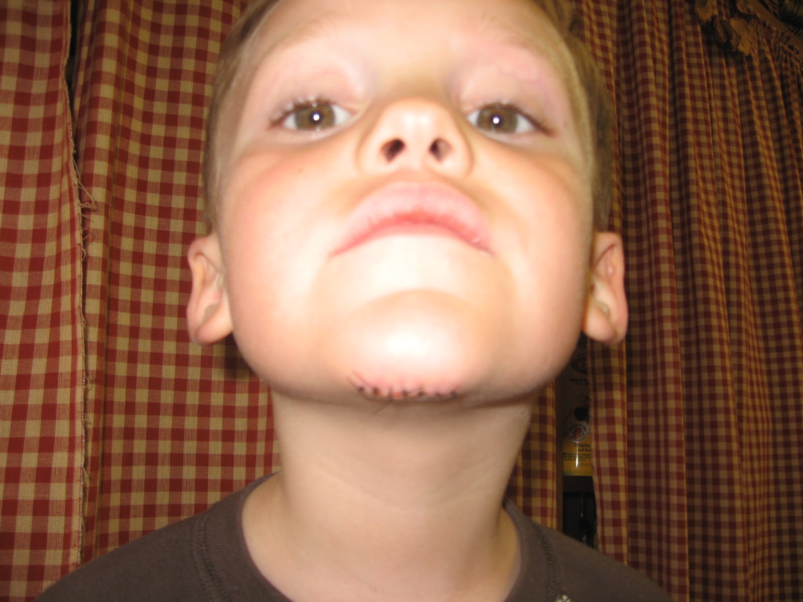 WEBER CITY SUPERKIDS: Uh Oh ~ stitches in my chin