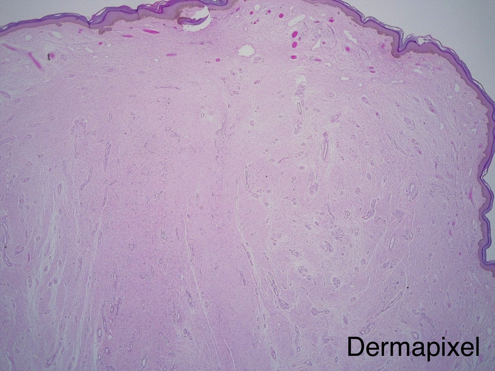 Dermapixel: El neurofibroma solitario