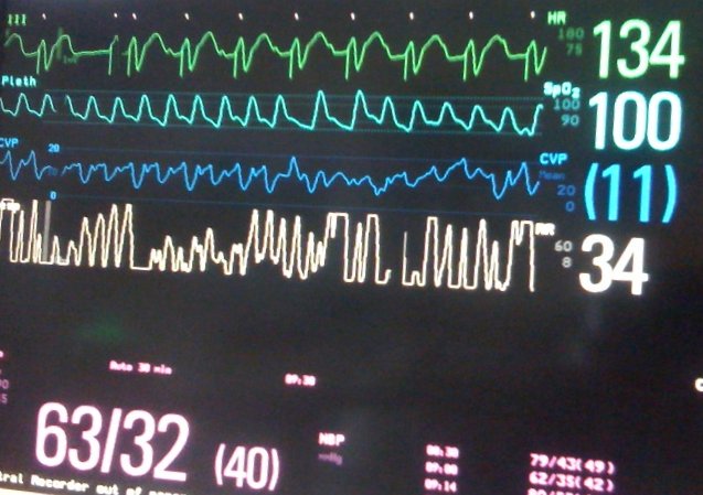 Pedi cardiology: ICU: Temporary pacemaker, DDD mode, Wenckebach