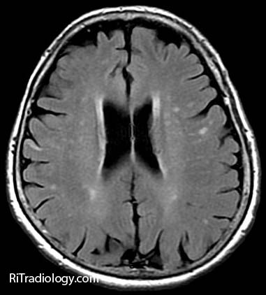RiT radiology: Age-related White Matter Changes