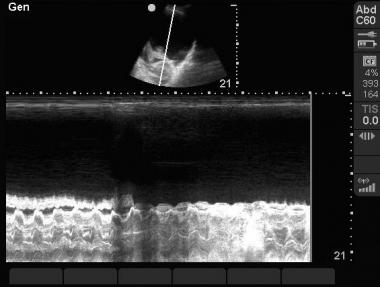 Dr. Saif ALaa ALqaisy: lung thoracentesis puncture site and technique