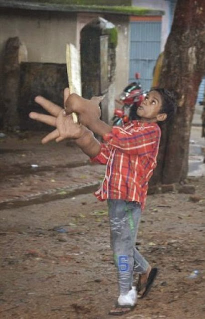 10 Gambar Budak Terkena Penyakit Tangan Gergasi Di India Harian Metro Online