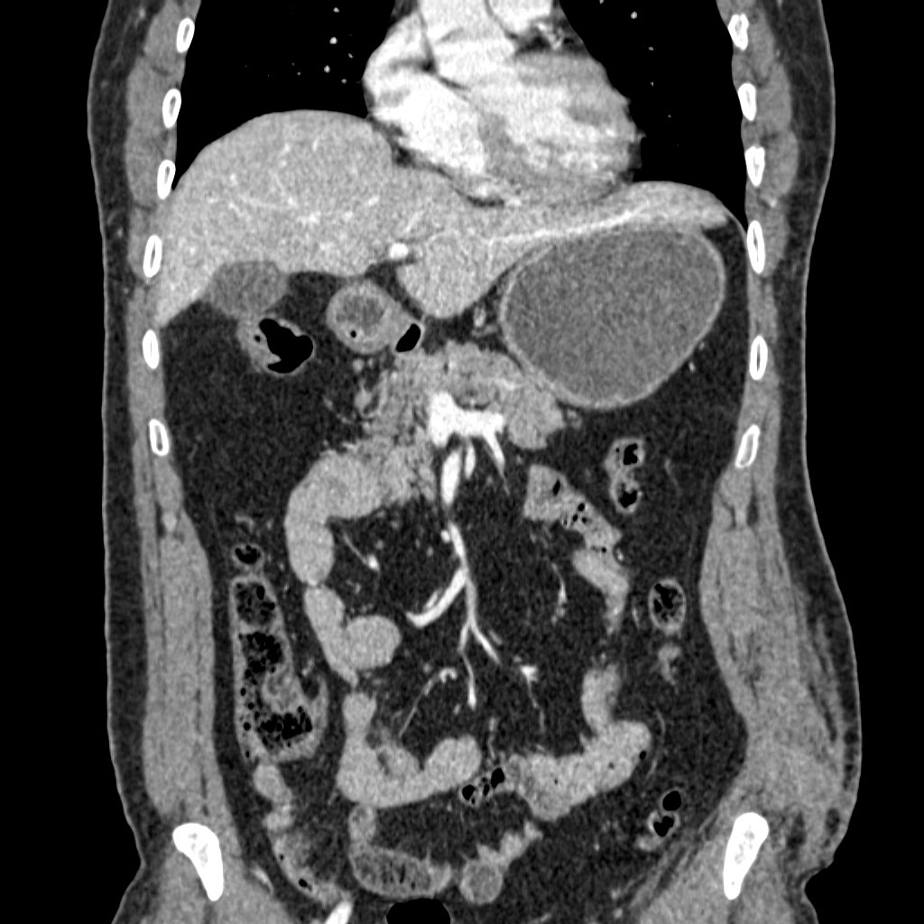 Radshare: PARTIAL MIDGUT MALROTATION