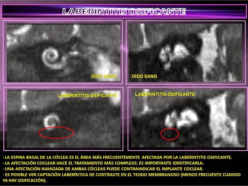 Patologías del oído: Patologías del oído medio , Laberintitis