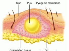 Skin Abscess: Causes, Symptoms and Prevention - The Thesis