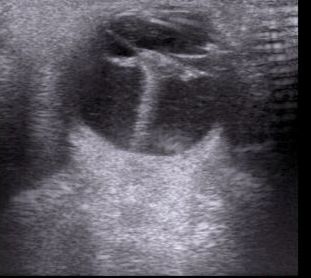 Persistent Hyperplastic Primary Vitreous : Case Report - Sumer's ...