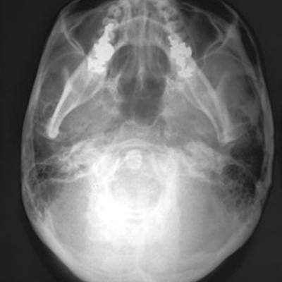 CIRUGÍA BUCAL I. BENEMÉRITA UNIVERSIDAD AUTÓNOMA DE PUEBLA, CAMPUS TEHUACÁN