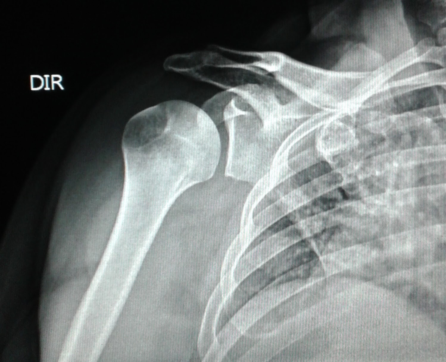 Rx Ombro Ap Verdadeiro - LIBRAIN