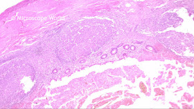 Microscope World Blog: Acute Suppurative Appendicitis under the Microscope