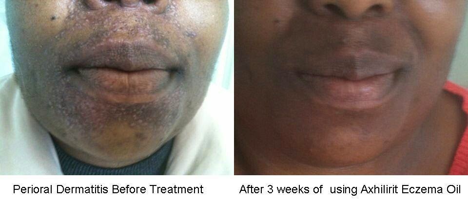 What can I use for: Perioral Dermatitis (Eczema around the mouth)