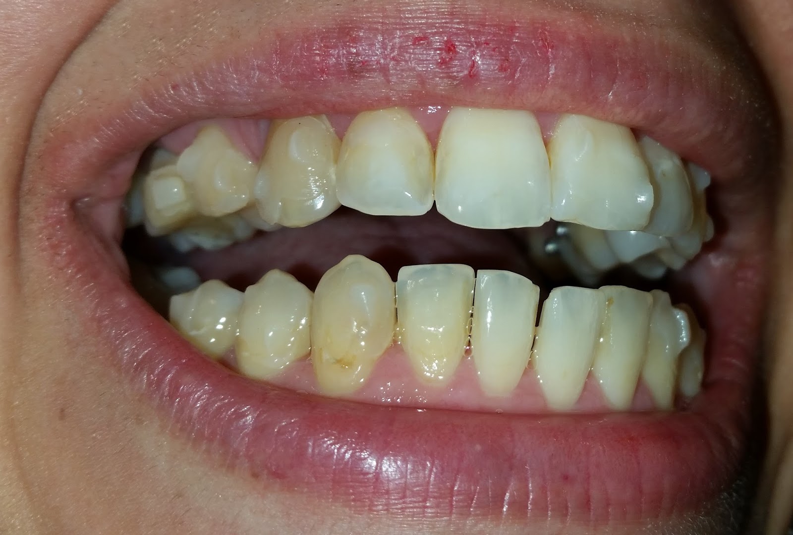 Mejorando mi sonrisa con INVISALIGN
