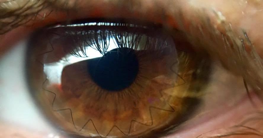 Márk's Corneal Transplant for Keratoconus (Photos) | Keratoconus Group