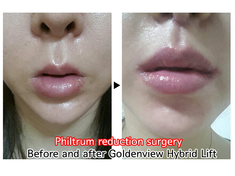 Goldenview Plastic surgery: Lip lift - philtrum surgery (philtrum ...