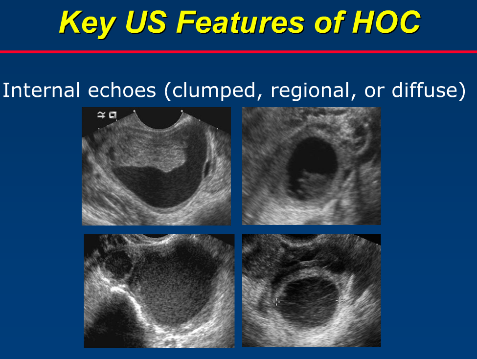 Rsna Hemorrhagic Ovarian Cyst rsna-hemorrhagic-ovarian-cyst