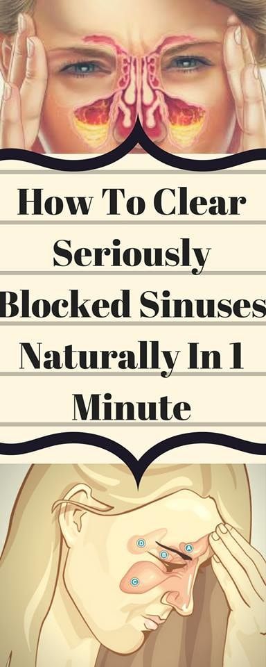HOW TO CLEAR SERIOUSLY BLOCKED SINUSES NATURALLY IN 1 MINUTE - HEALTH ...