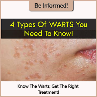 Wart Remover Tips: 4 Types Of Warts – Which One Do You Have? Find Out Now!