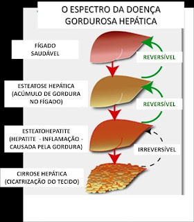 Professora Blogueirinha: VOCÊ SABE O QUE É ESTEATOSE HEPÁTICA?