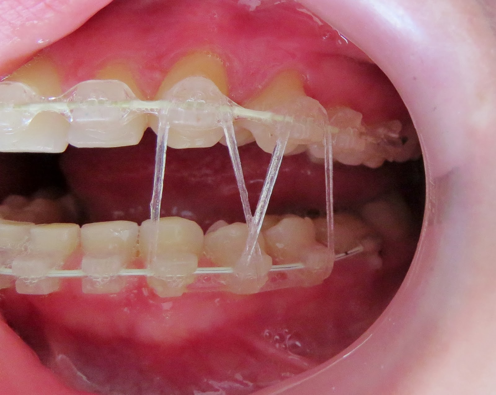 Ortodontia.com.Borel: Elásticos na ortodontia... tá amarrado!!