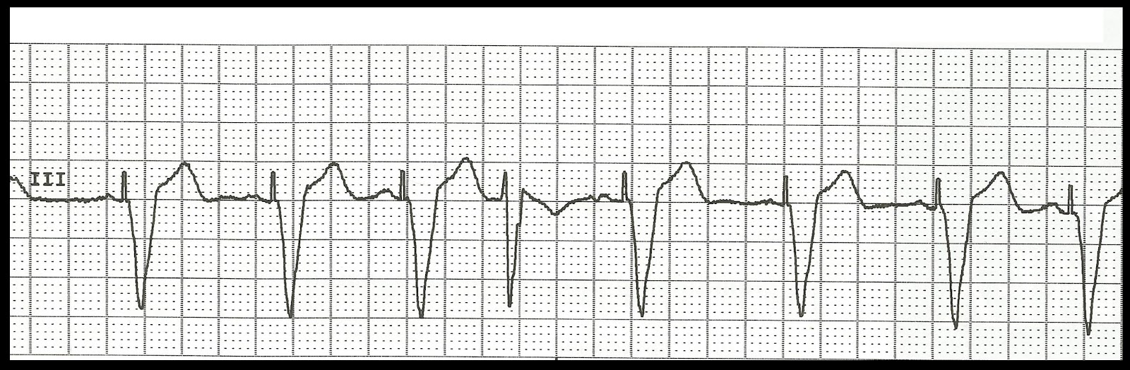 Basic EKG Rhythm Test 06