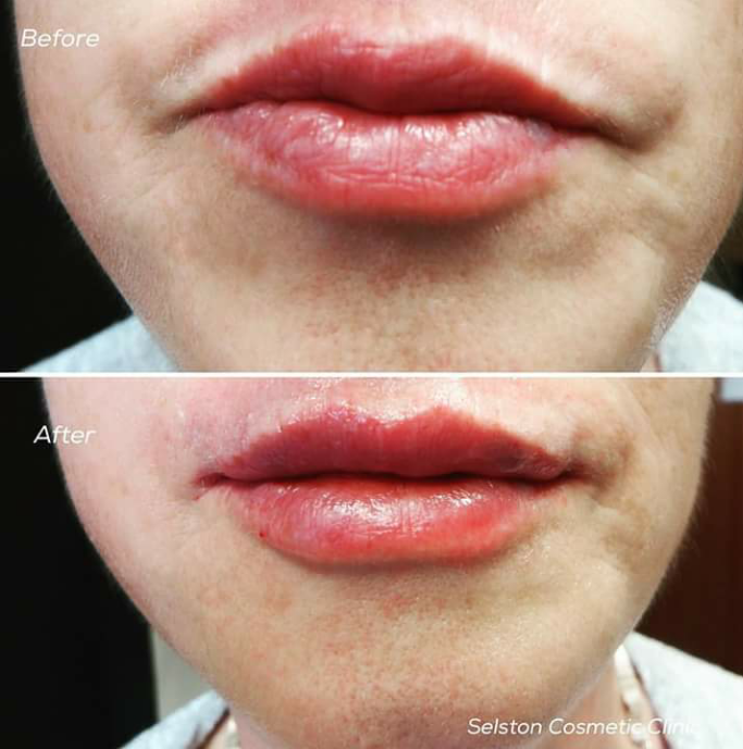 Selston Cosmetic Clinic: Improve Flat & Unbalanced Lips with Lip Filler ...