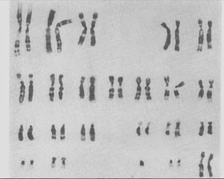 MONOSOMIA DEL 21: Estudio cariotipo