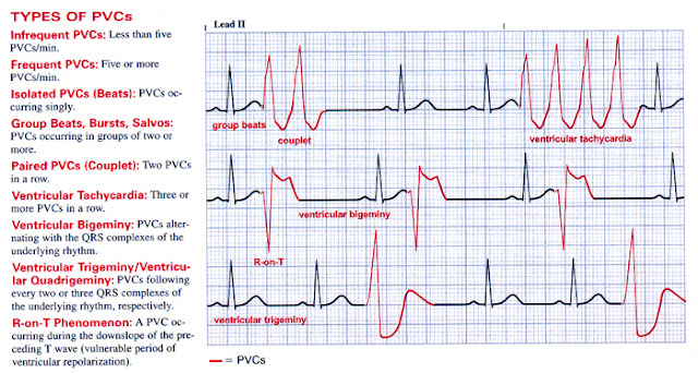Premature Ventricular Contraction (PVC) - JANTUNG OKE