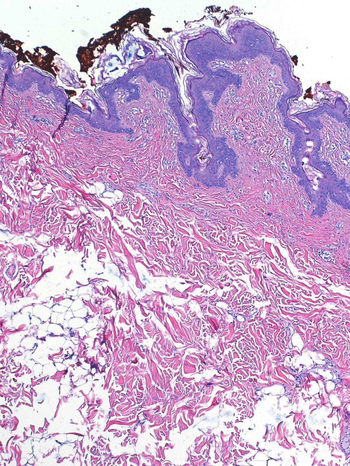VIRTUAL GRAND ROUNDS IN DERMATOLOGY 2.0: Nevus Lipomatosus Superficialis