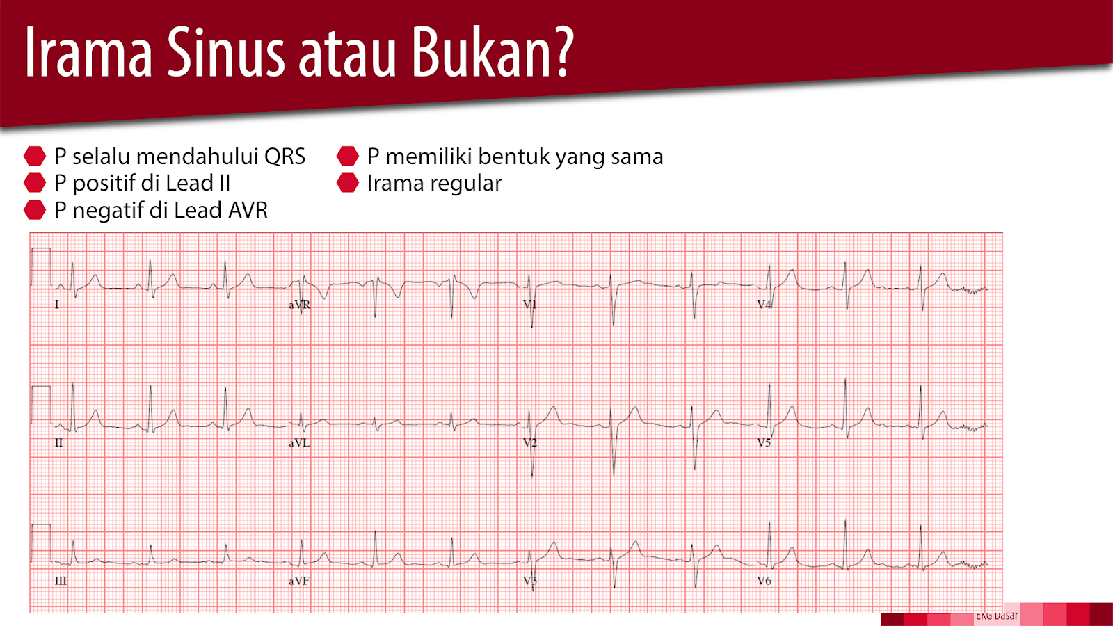 EKG Dasar; Workshop EKG | Dokter Alfa : Belajar Kedokteran