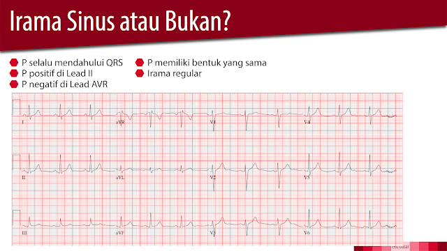 EKG Dasar; Workshop EKG | Dokter Alfa : Belajar Kedokteran