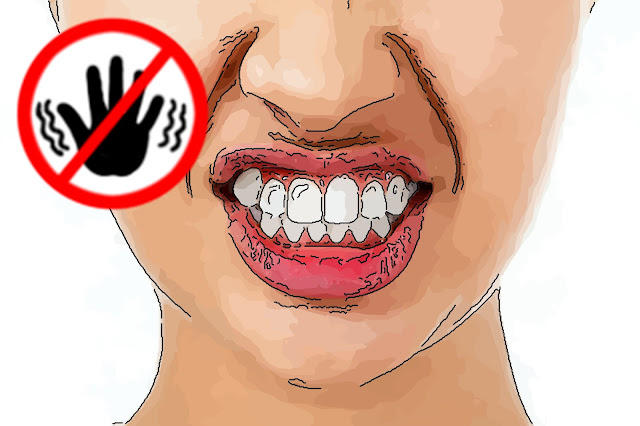 Teeth Grinding - Bruxism (Clenching)