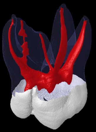 The Root Canal Anatomy Project: Maxillary First Molar: Five Canals