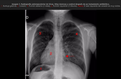 Situs Inversus: Anatomía y Radiología