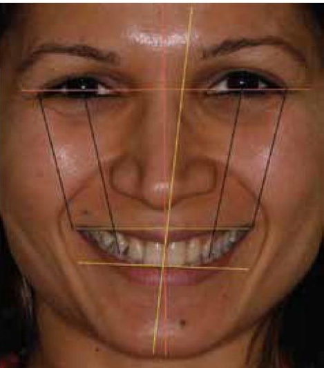 Smile evaluation using research. Facial and dental analysis