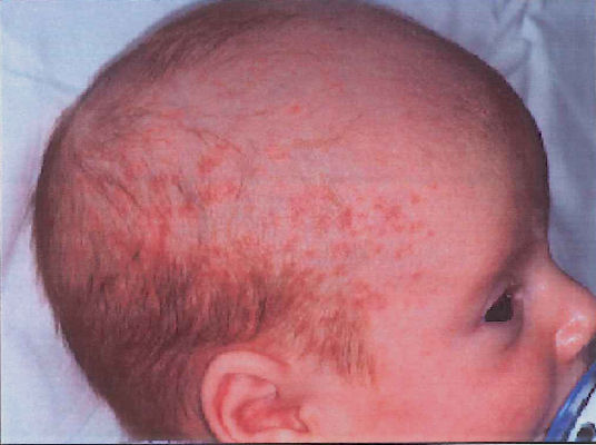 A Dull Day At Work...?: May 18, 2011 (Wednesday) - Neonatal Lupus