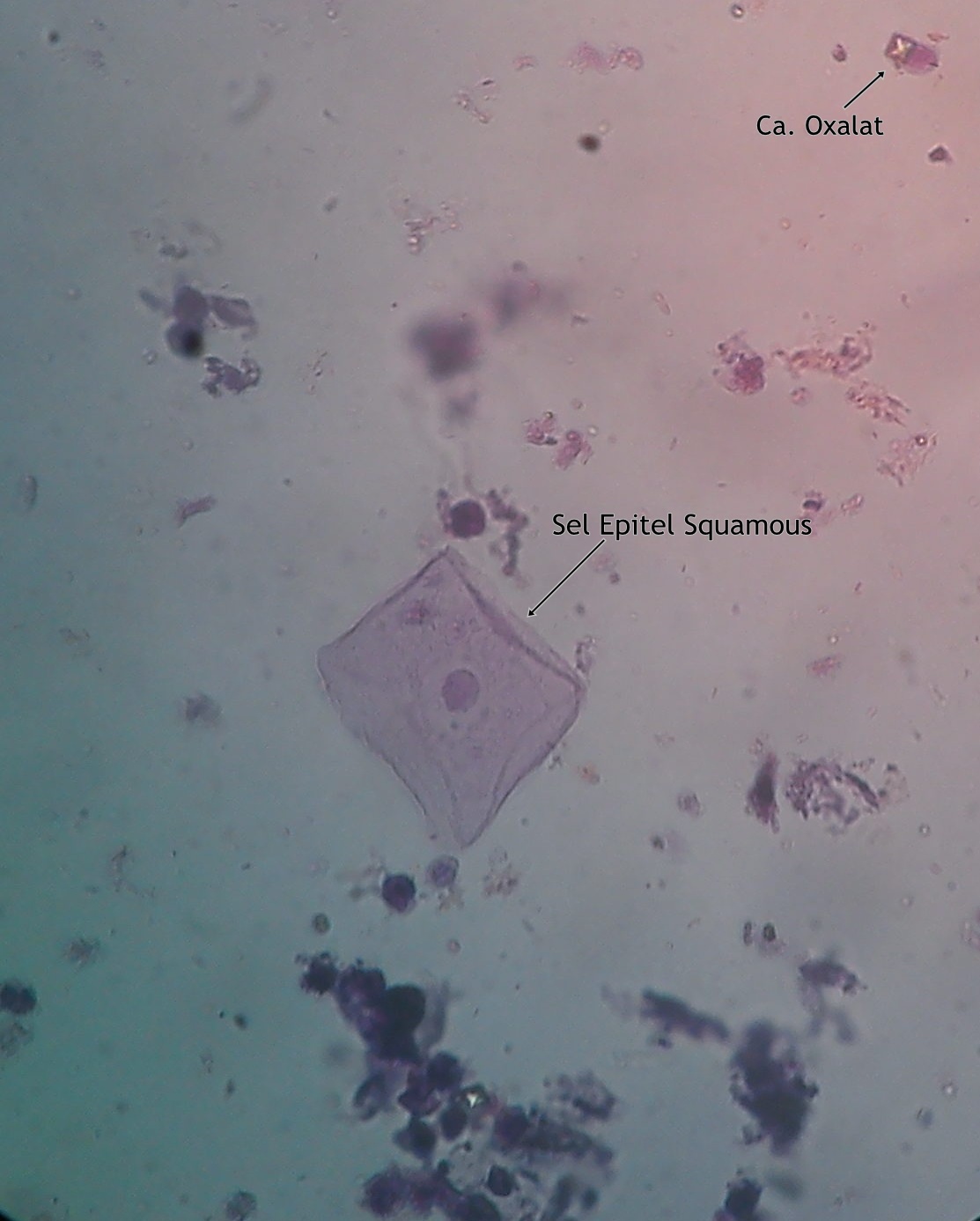 Sedimen Urine (Stainning) | Analis Kesehatan