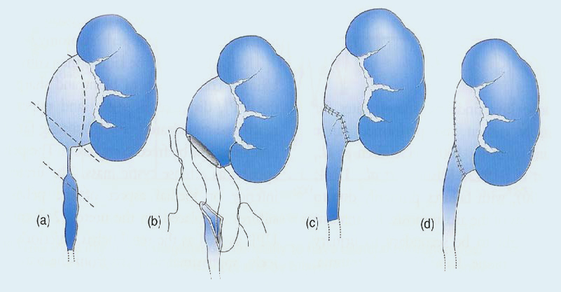 Upj Obstruction Causes Symptoms Treatment Upj Obstruction