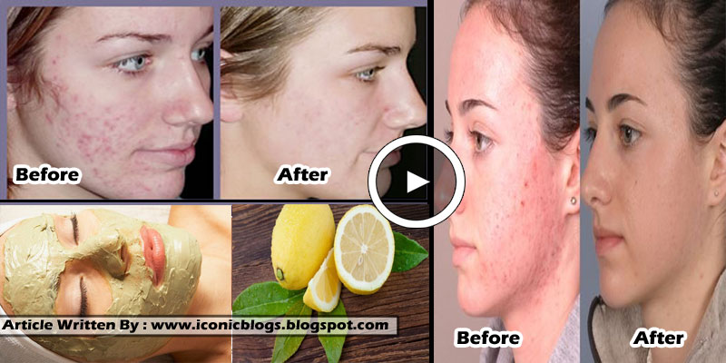 How To Remove Acne Marks Satisfying Result Iconic Blogs
