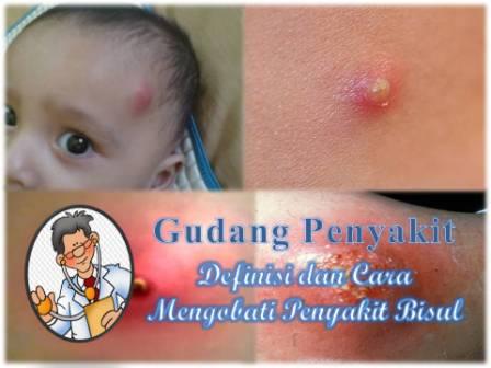 Definisi dan Cara Mengobati Penyakit Bisul | Gudang Penyakit
