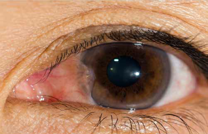 ¿Por que sale carnosidad en los ojos ? ~ Salud las 24 Horas