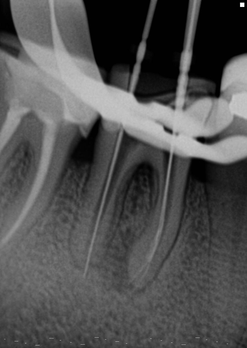 Patrick Baltieri: Dente 46 - EXODONTIA ou RETRATAMENTO?