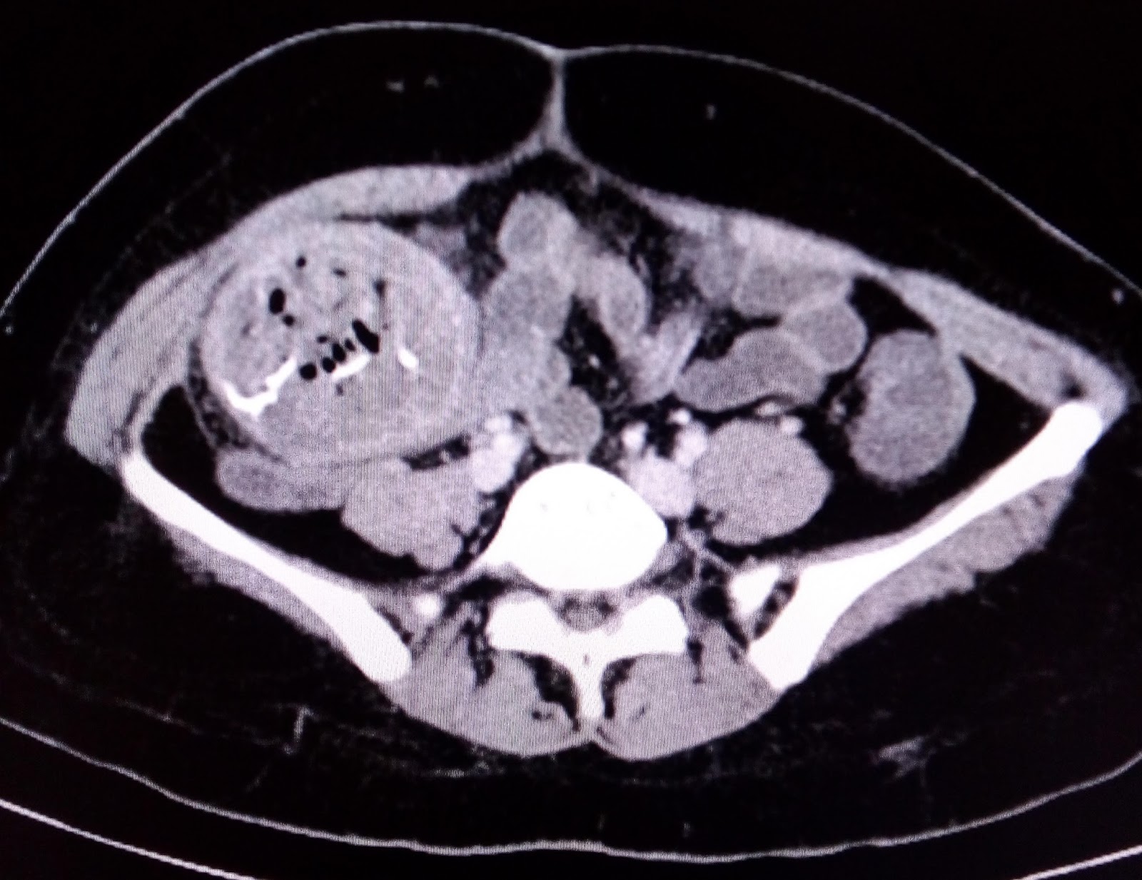 Two cases of Gossypiboma -Teaching Points - Sumer's Radiology Blog