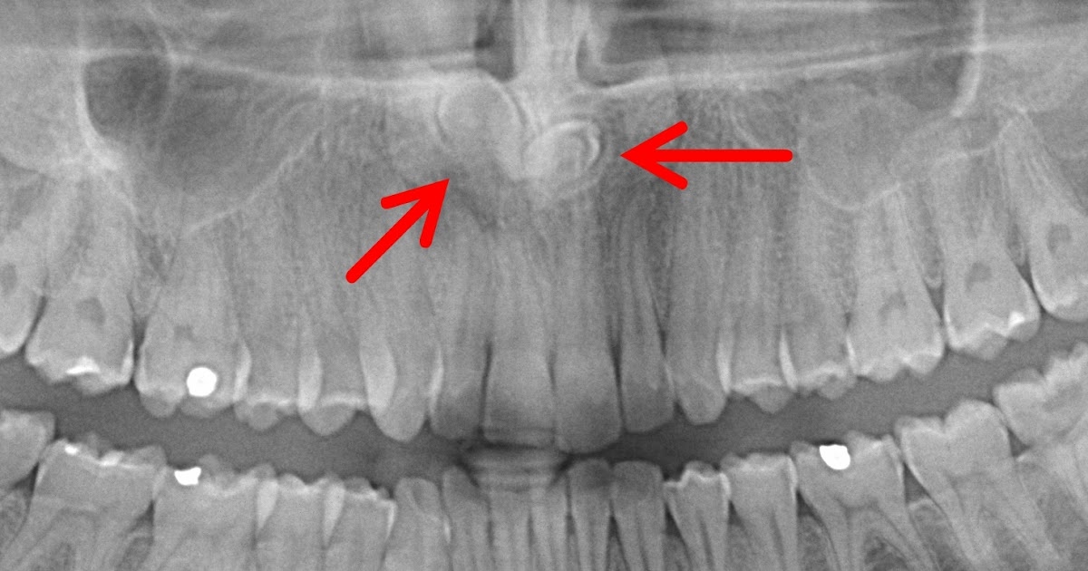"Te vejo por dentro": Dentes supranumerários