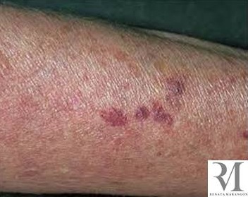 Fisioterapia em Pós Operatório de Cirurgias Plásticas: Hematoma ou ...