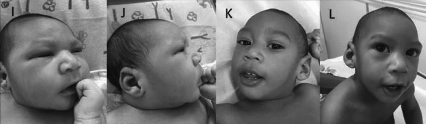 Normal head size at birth doesn’t rule out microcephaly, Zika syndrome ...
