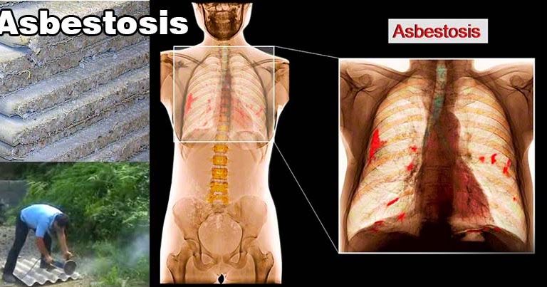 Asbestosis | Nurselk.com