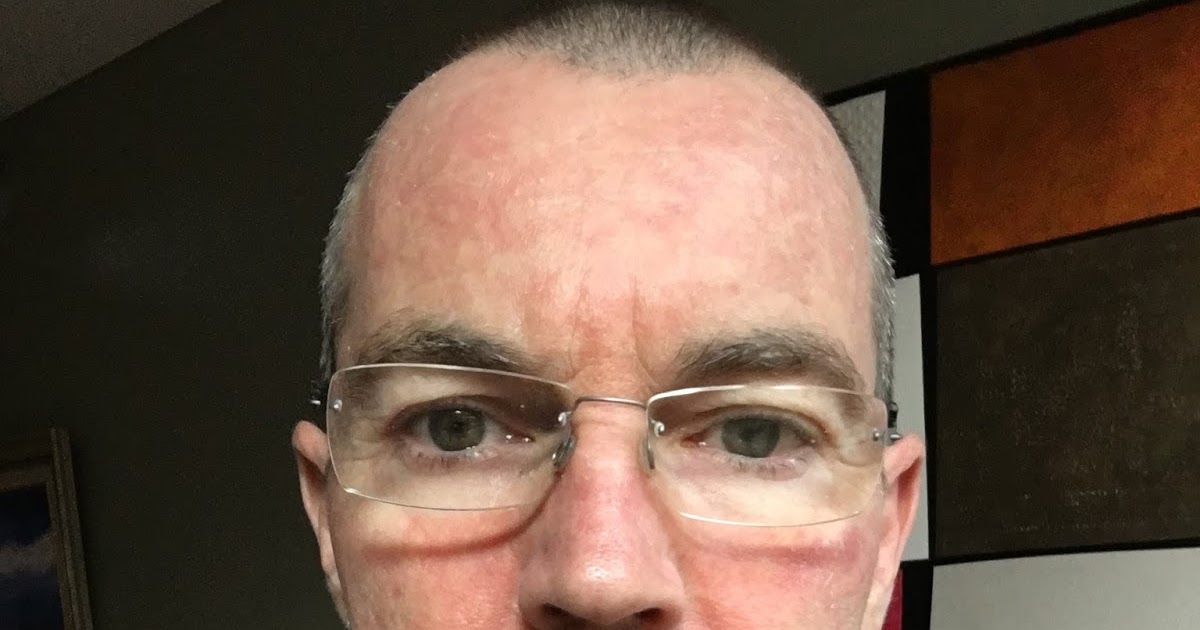 Efudix Treatment: Day 31 - Post Day 11