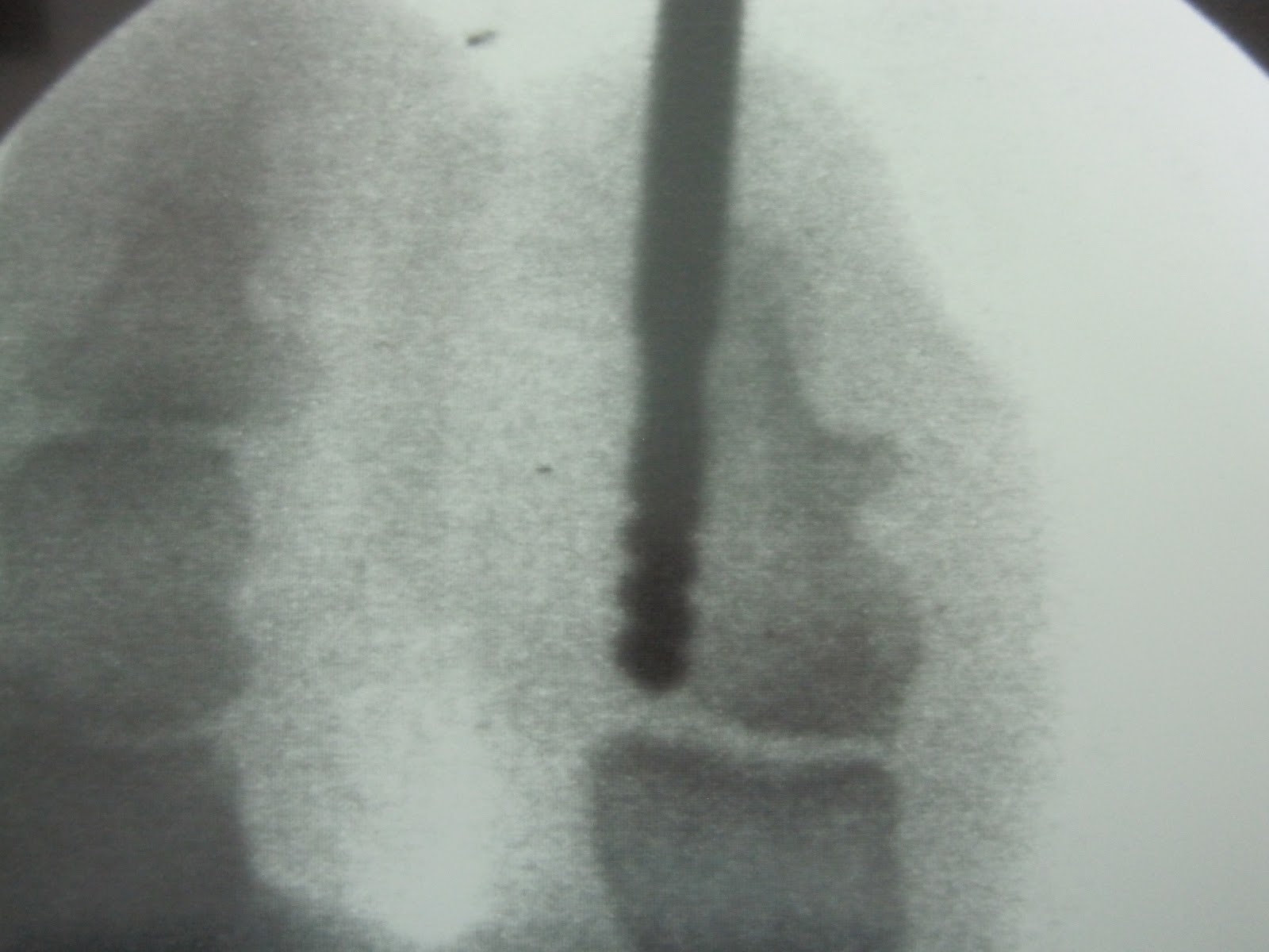 Podo Basas al Día: Heloma interdigital, ojo de gallo, callo ...