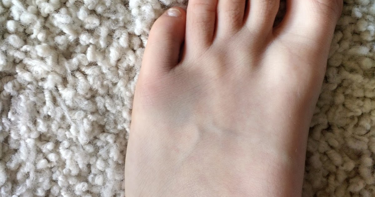 Sylvia's Blog: What to do for a broken toe? It depends who you ask...