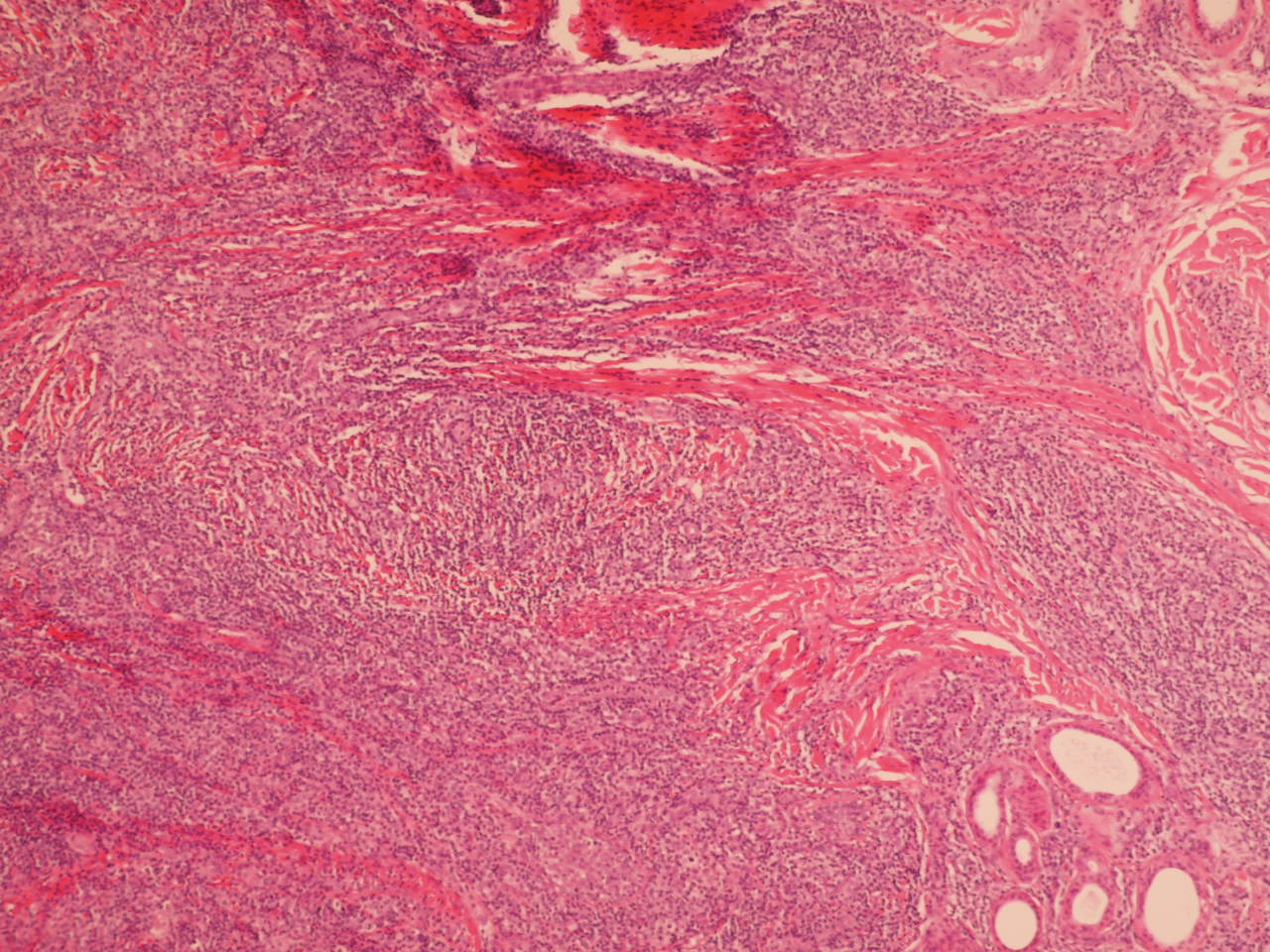 VIRTUAL GRAND ROUNDS IN DERMATOLOGY 2.0: Nasal Tumor for Diagnosis